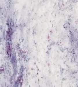 Low Grade Squamous Intraepithelial Lesion (LSIL) - Causes, Symptoms ...