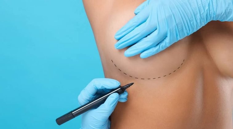 Understanding 800cc Breast Implants A Comprehensive Guide Mybeautygym 8243